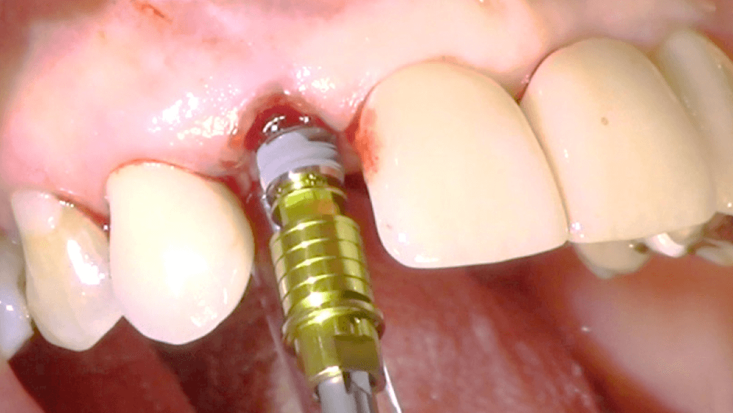 NovoMatrix: Camlog Biomaterial zur Weichgewebe Regeneration