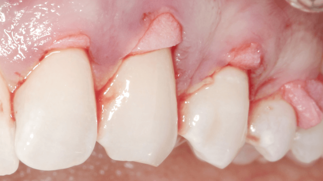 NovoMatrix: Camlog Biomaterial zur Weichgewebe Regeneration