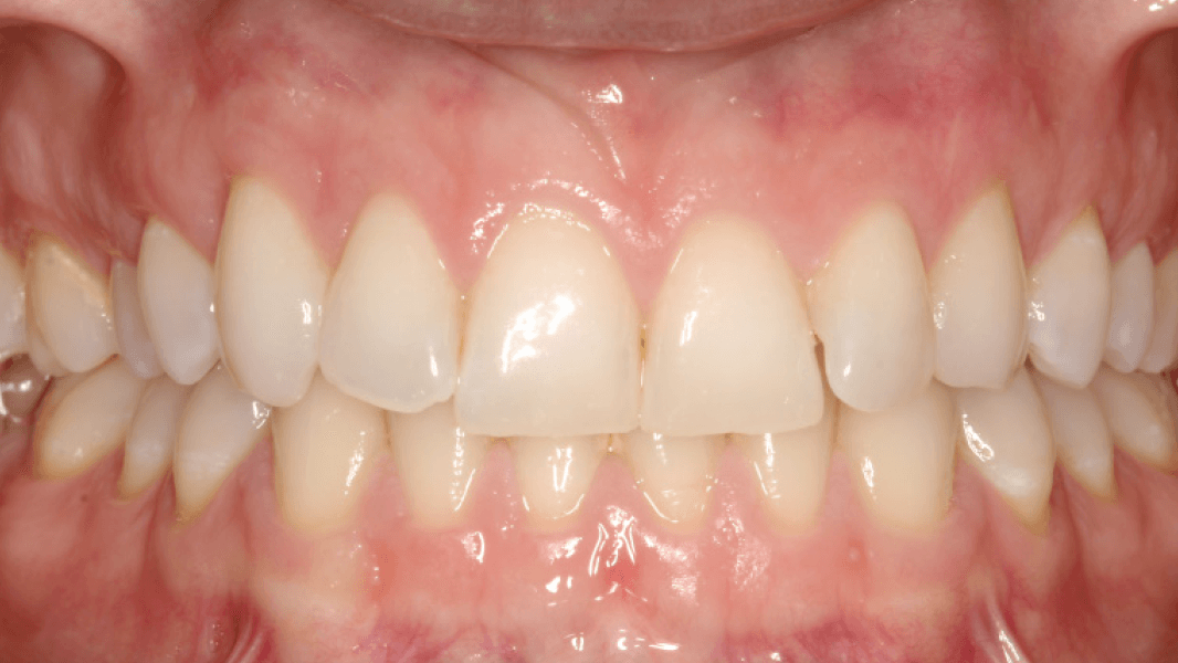 NovoMatrix: Camlog Biomaterial zur Weichgewebe Regeneration