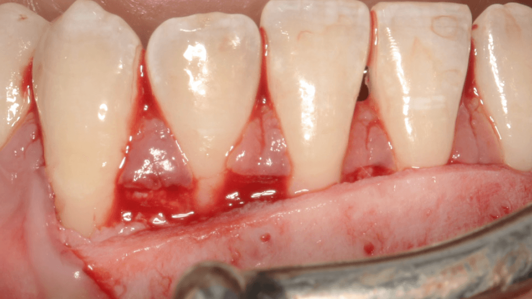 NovoMatrix: Camlog Biomaterial zur Weichgewebe Regeneration