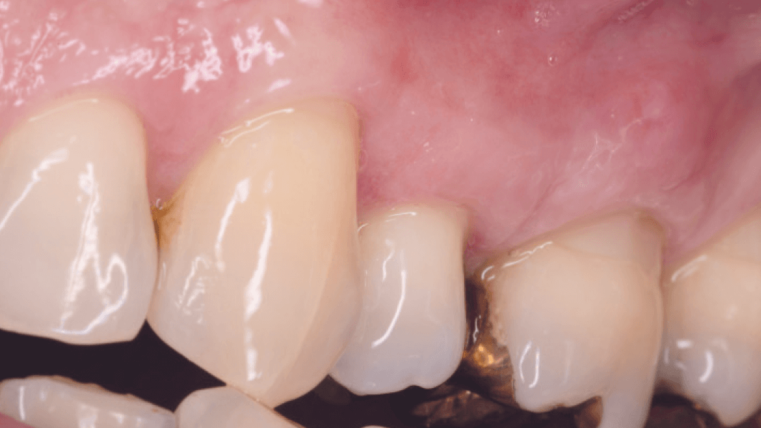 NovoMatrix: Camlog Biomaterial zur Weichgewebe Regeneration