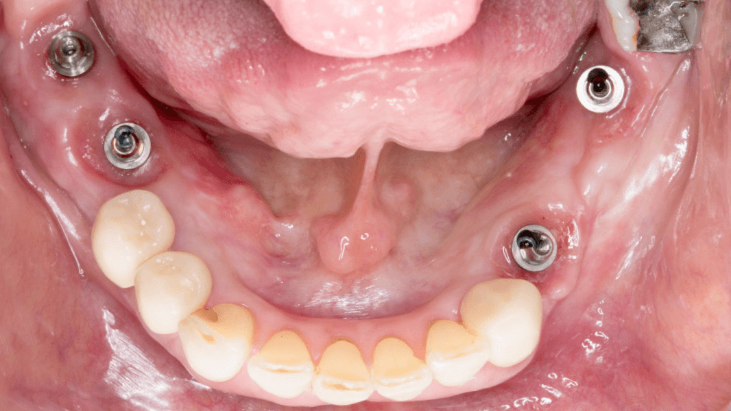 NovoMatrix: Camlog Biomaterial zur Weichgewebe Regeneration